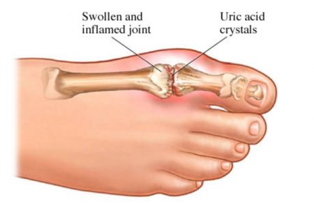 High Uric Acid Levels – Causes And Treatment